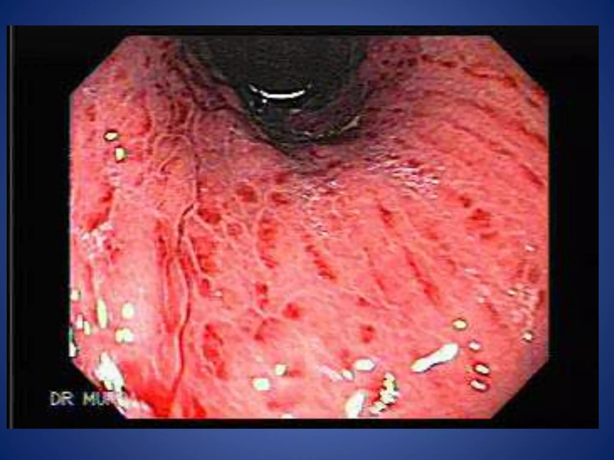 Hyper acidity or acute or chronic gastritis | PPTX