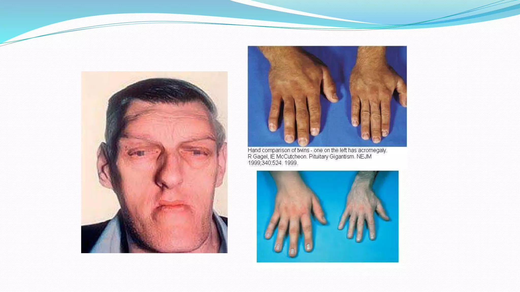 Hyperactivity of anterior pituitary gland | PPTX