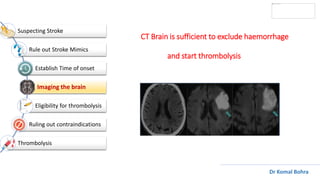 Hyperacute Management of Stroke Template.pptx