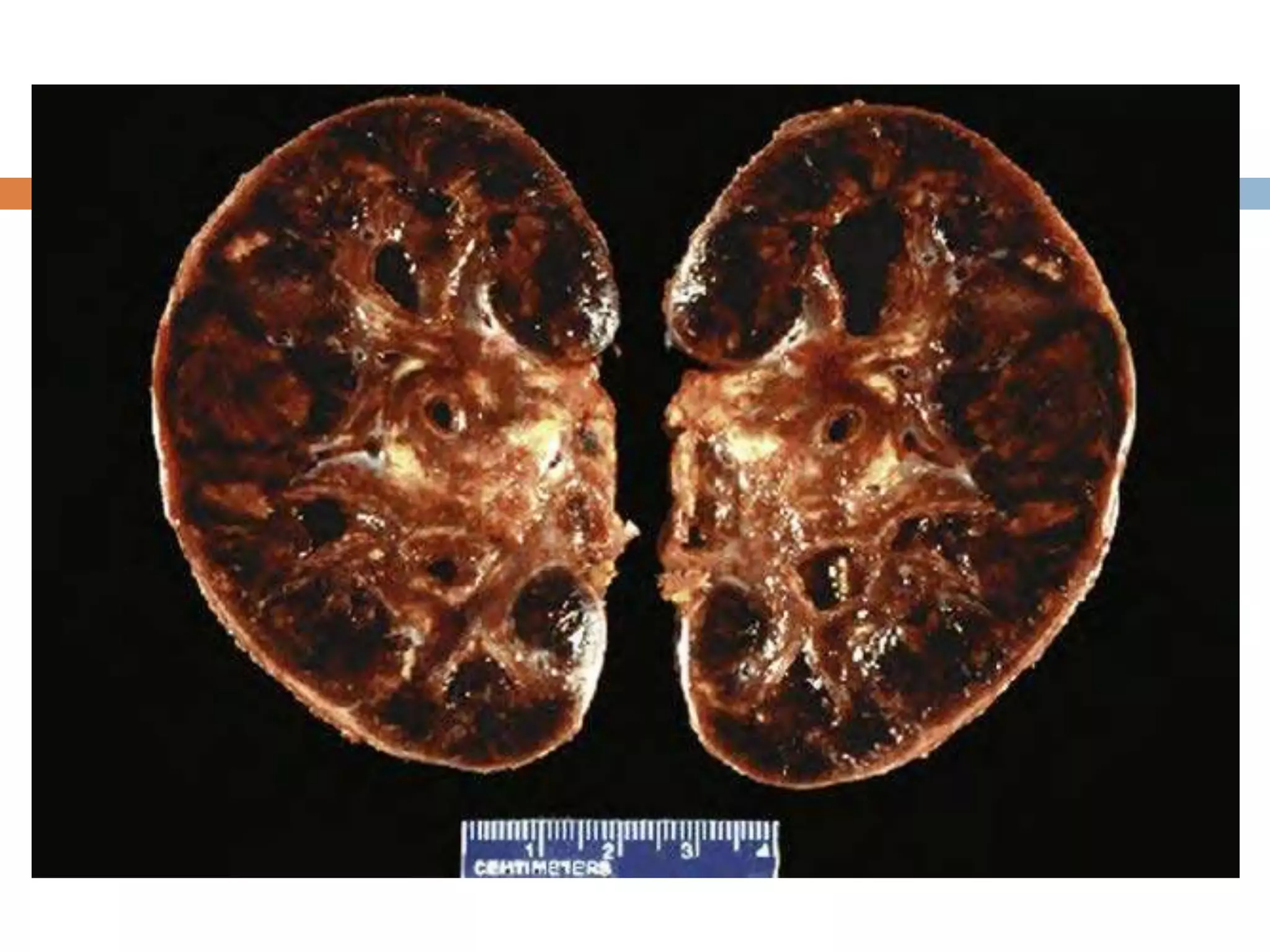 Hyperacute Rejection of Renal Transplants | PPTX