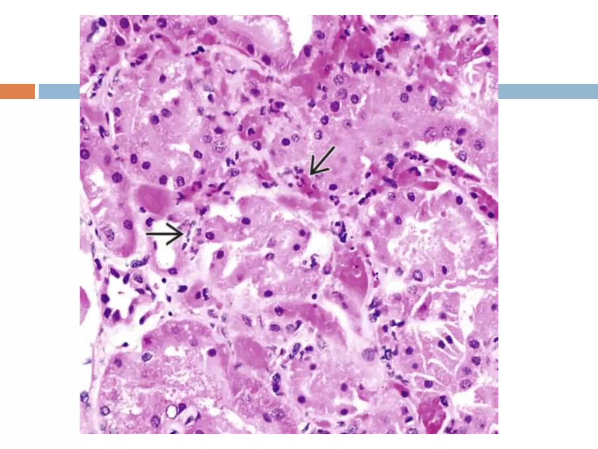 Hyperacute Rejection of Renal Transplants | PPTX