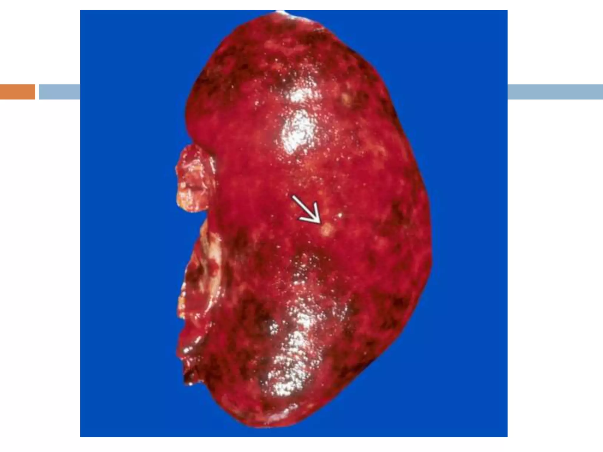 Hyperacute Rejection of Renal Transplants | PPTX