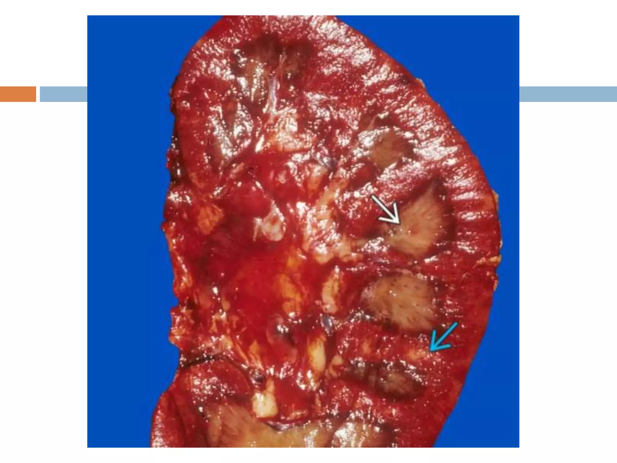 Hyperacute Rejection of Renal Transplants | PPTX