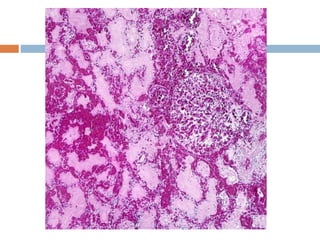 Hyperacute Rejection of Renal Transplants | PPTX