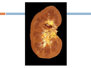 Hyperacute Rejection of Renal Transplants | PPTX