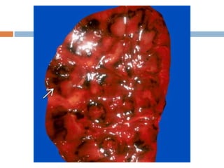 Hyperacute Rejection of Renal Transplants | PPTX