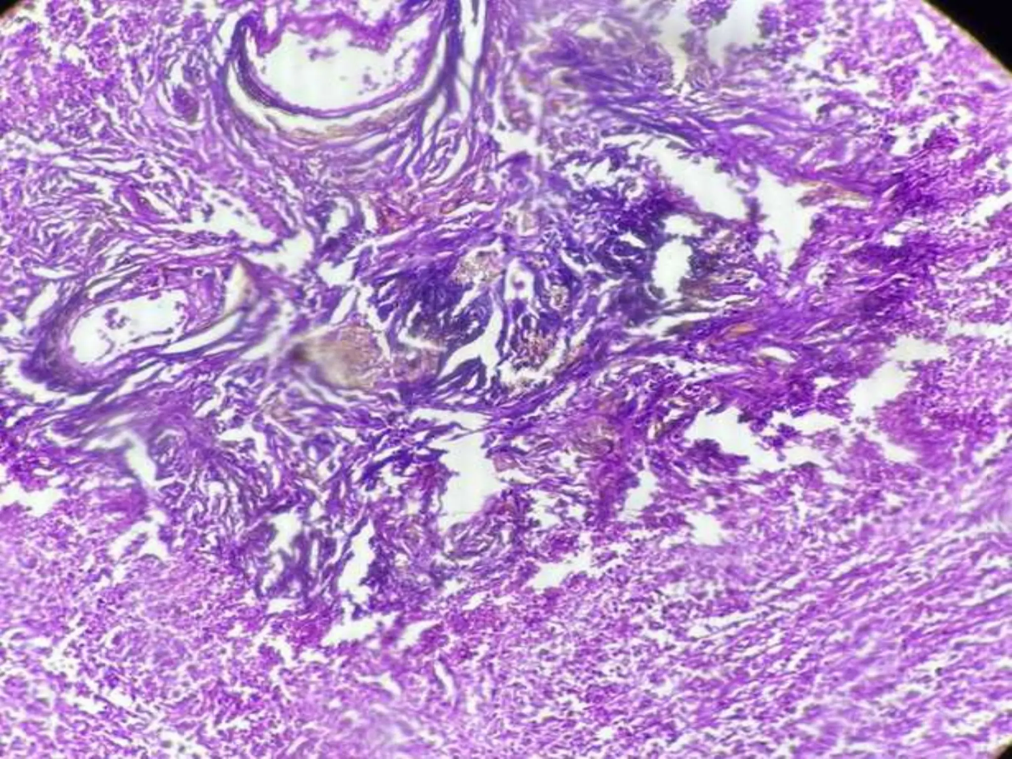 HYPERAEMIA congrstion haemoorhage cvc spleen | PPT