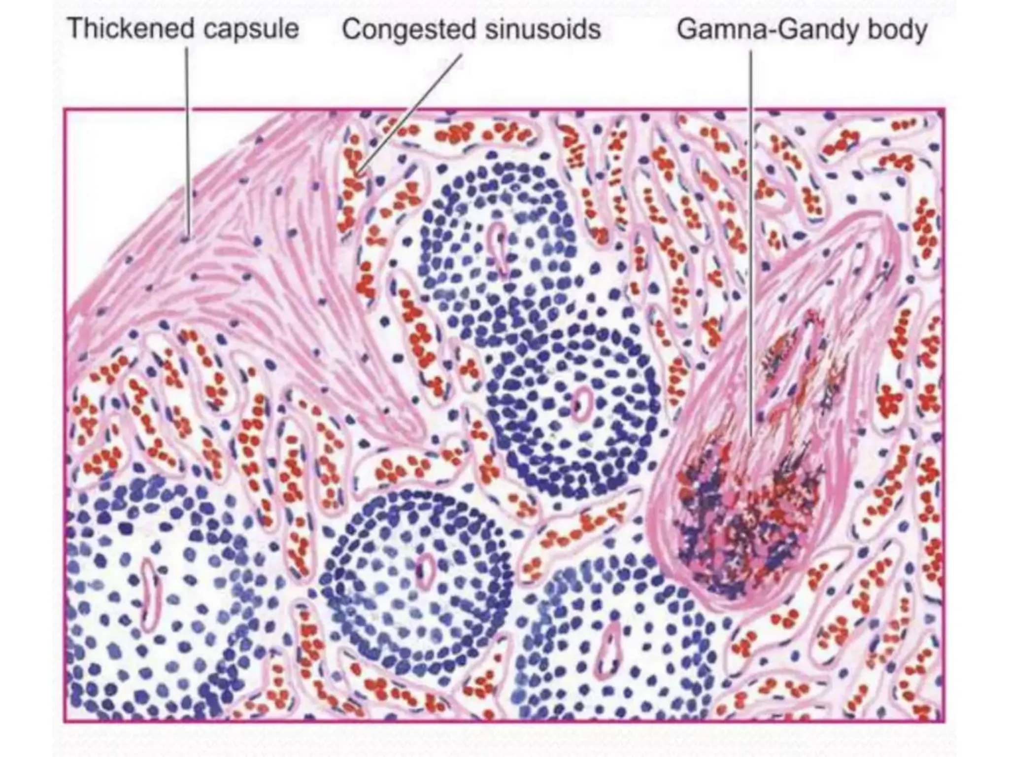 HYPERAEMIA congrstion haemoorhage cvc spleen | PPT