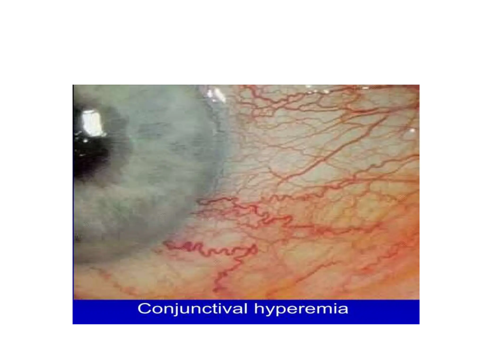 HYPERAEMIA congrstion haemoorhage cvc spleen | PPT