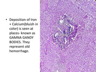 HYPERAEMIA congrstion haemoorhage cvc spleen | PPTX