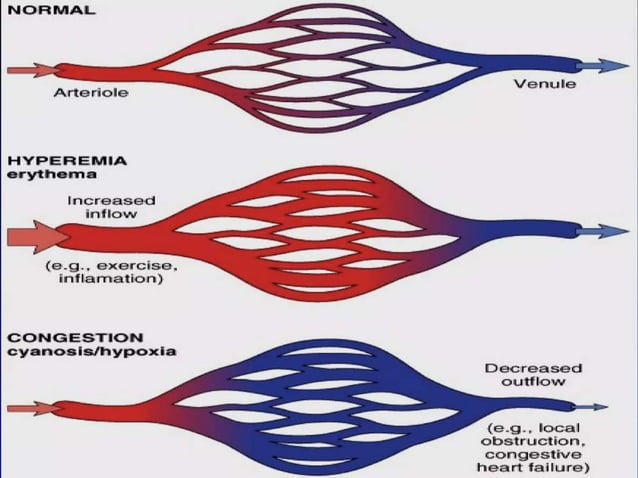 HYPERAEMIA congrstion haemoorhage cvc spleen | PPT