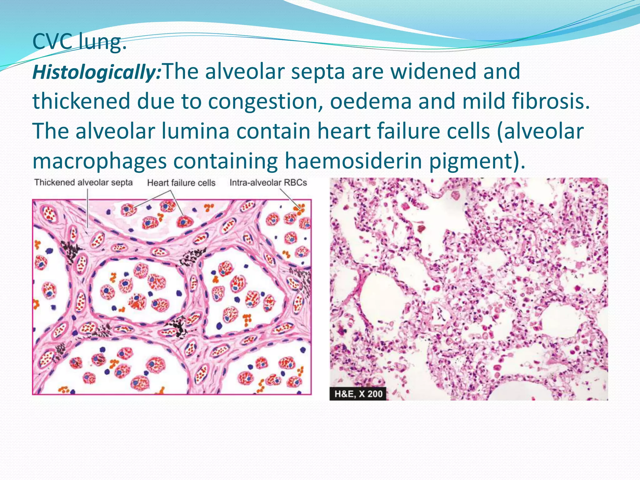 HYPERAEMIA & CONGESTION | PPTX