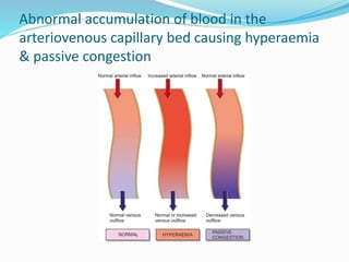 HYPERAEMIA & CONGESTION | PPTX
