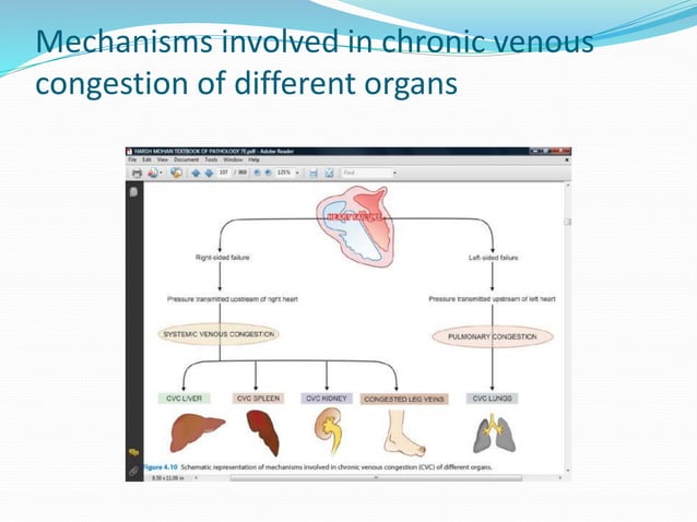 HYPERAEMIA & CONGESTION | PPTX | Lung and Respiratory Health | Diseases ...