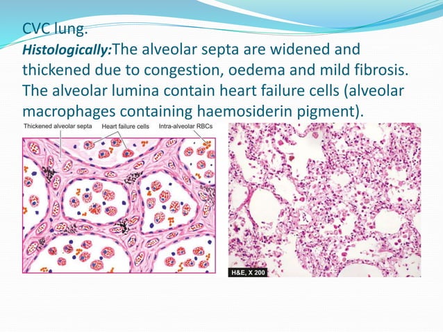HYPERAEMIA & CONGESTION | PPTX | Lung and Respiratory Health | Diseases ...