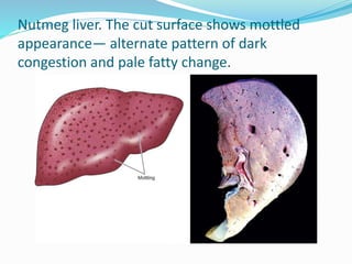 HYPERAEMIA & CONGESTION | PPTX