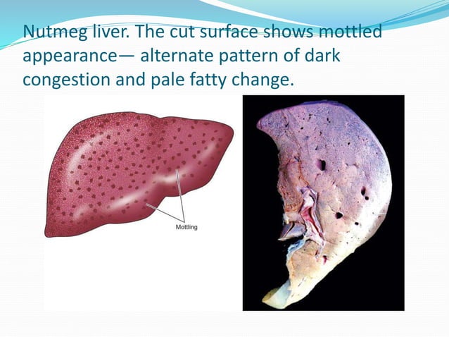 HYPERAEMIA & CONGESTION | PPTX | Lung and Respiratory Health | Diseases ...