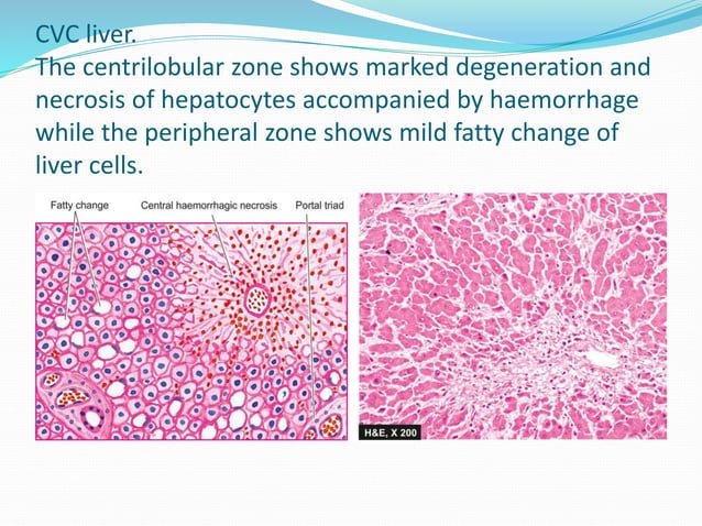 HYPERAEMIA & CONGESTION | PPTX | Lung and Respiratory Health | Diseases ...