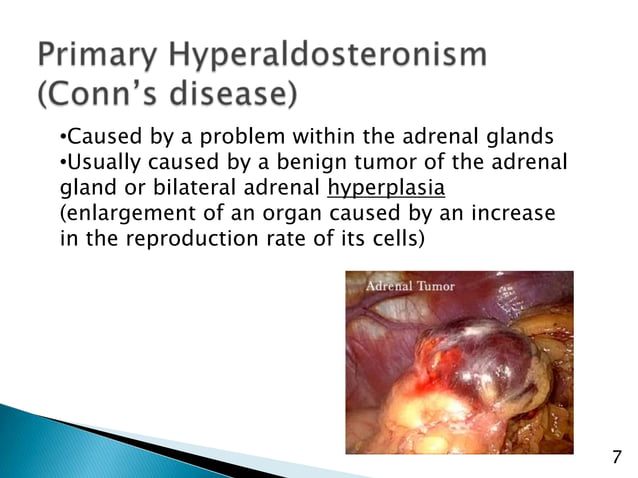 Hyperaldosteronism