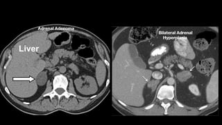 Hyperaldosteronism | PDF