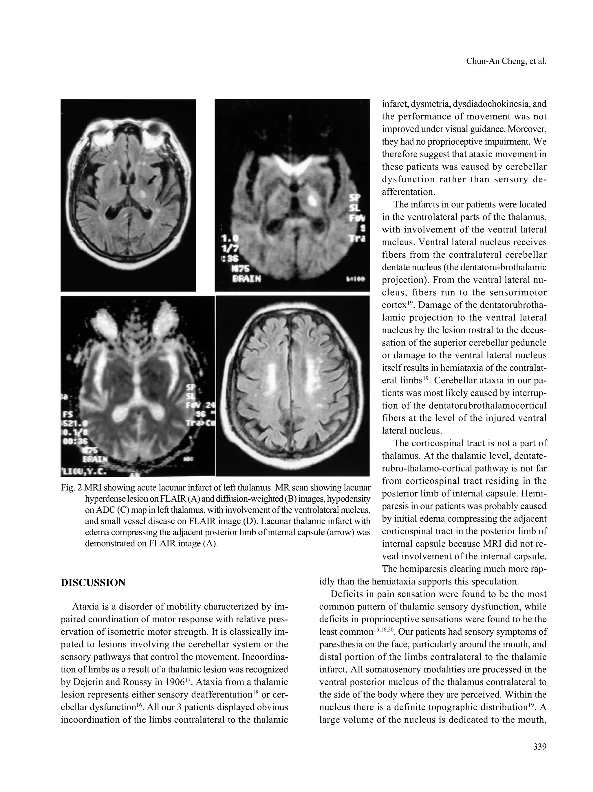 Hyperasthetic ataxic syn aftr thal infarct | PDF