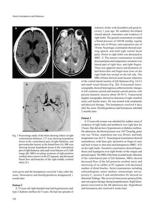 Hyperasthetic ataxic syn aftr thal infarct | PDF