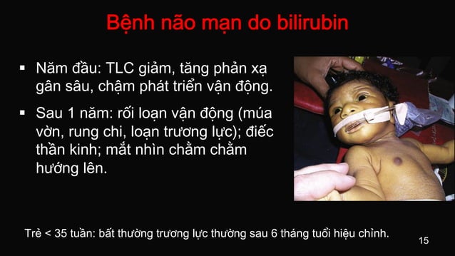 Vàng da tăng Bilirubin gián tiếp ở trẻ sơ sinh - 2019 - Đại học Y dược TPHCM | PDF