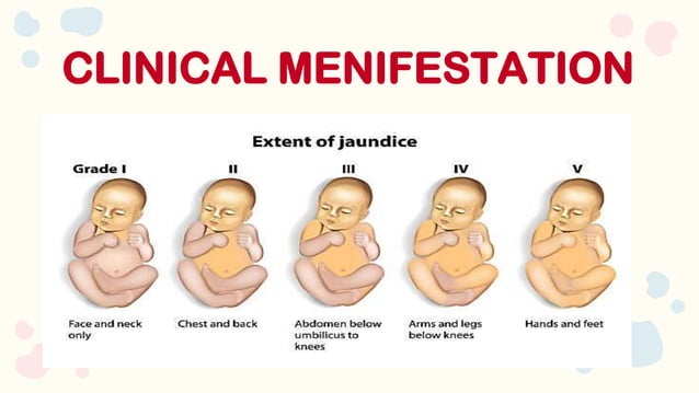 Neonatal hyperbilirubinemia pediatric nursing | PPTX