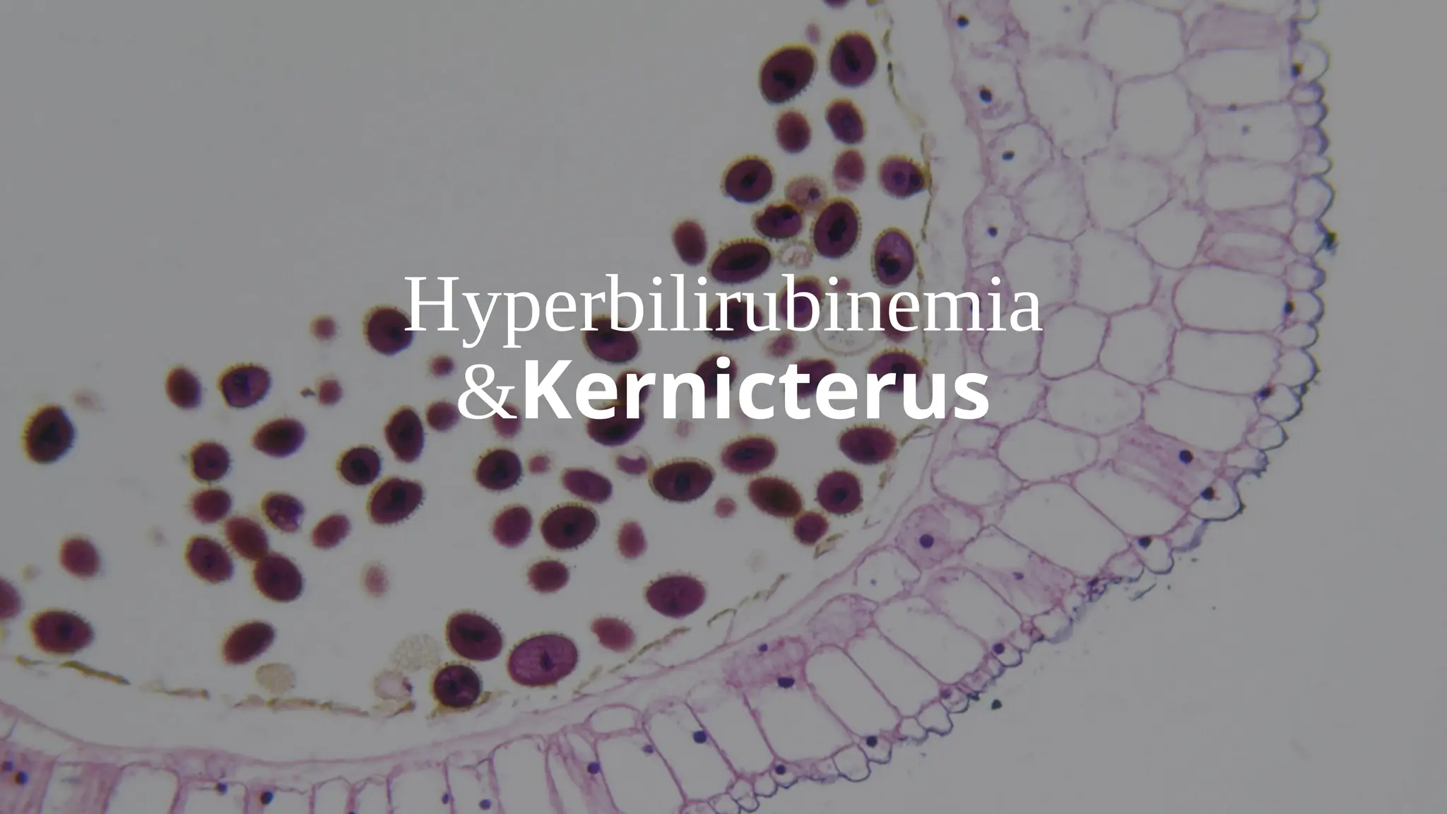 Hyperbilirubinemia ,Kernicterus , bilirubin encephalopathy | PPTX