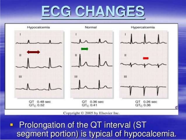 Hypercalcemia and hypocalcemia