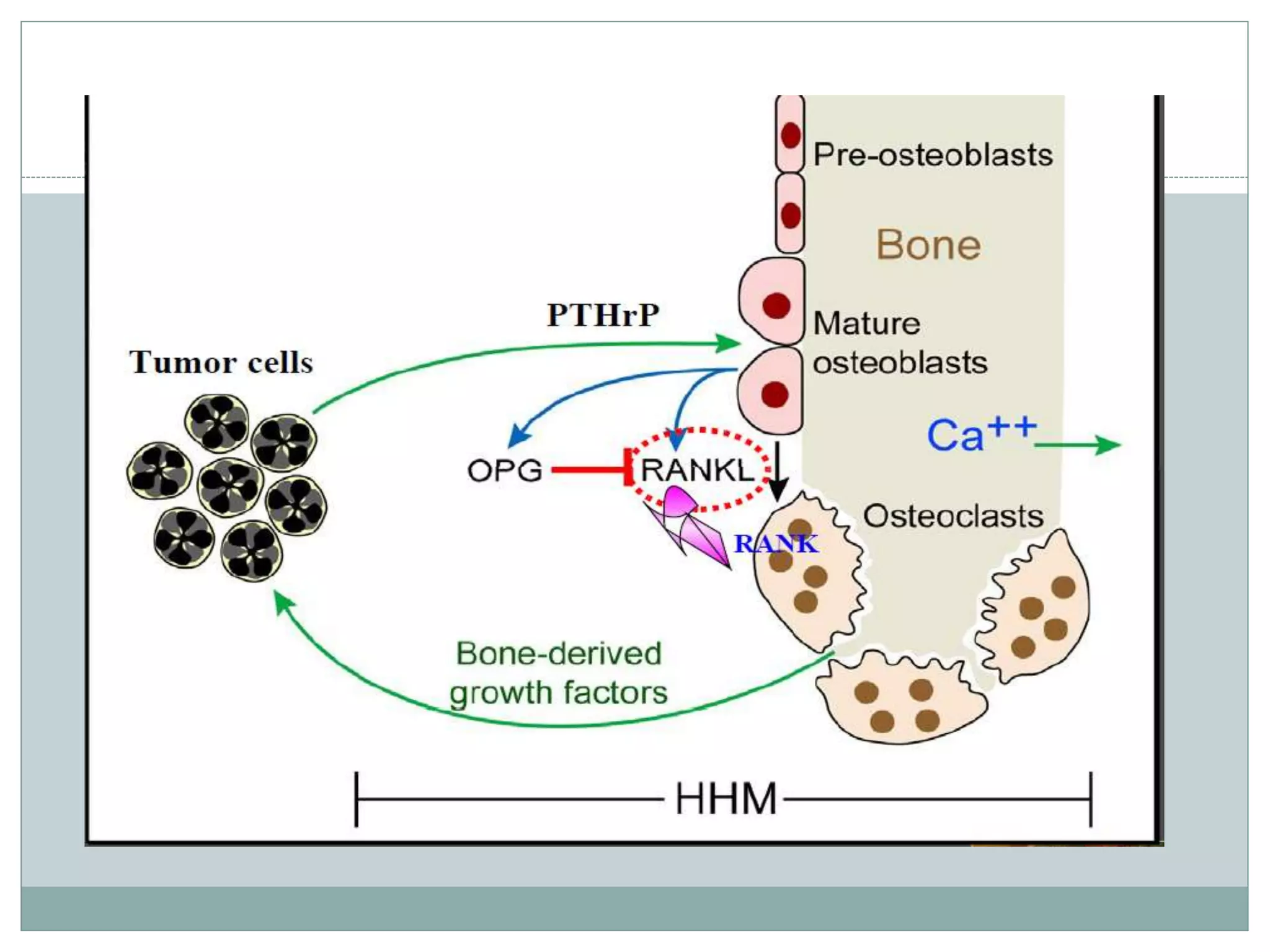 Hypercalcemia in malignancy | PPTX