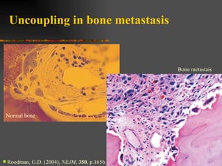 Hypercalcemia of malignancy | PPT