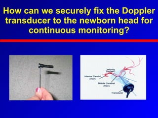 Hypercapnia On Cerebral Autoregulation | PPT