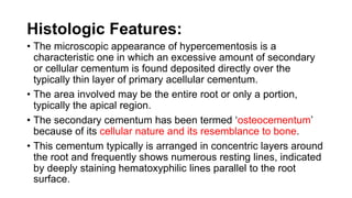 Hypercementosis | PPTX