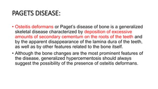Hypercementosis | PPTX