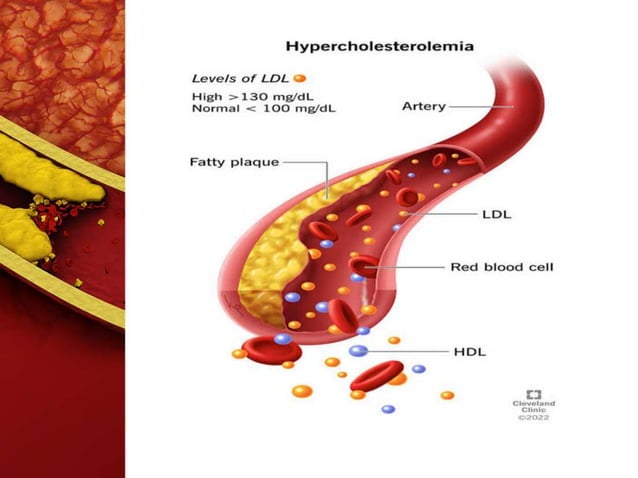 HYPERCHOLESTROLEMIA.pptx