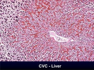 HYPEREMIA- CONGESTIONpathology mbbs 2nd year | PPTX