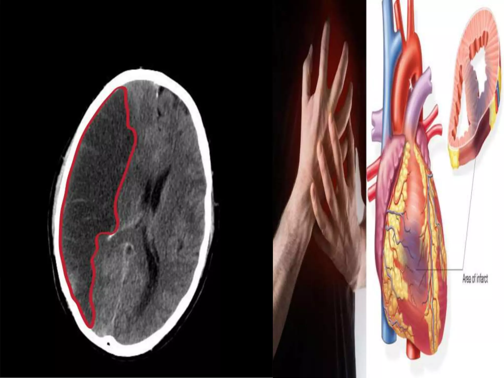 Hyperemia and infarction | PPTX