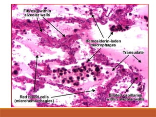 hyperemia,congestion,edema.SAS PPT.pptx mbbs | PPTX