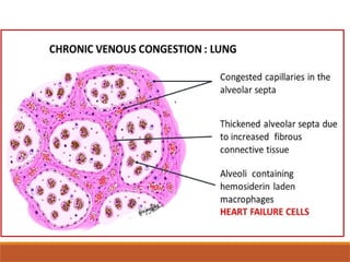 hyperemia,congestion,edema.SAS PPT.pptx mbbs | PPTX