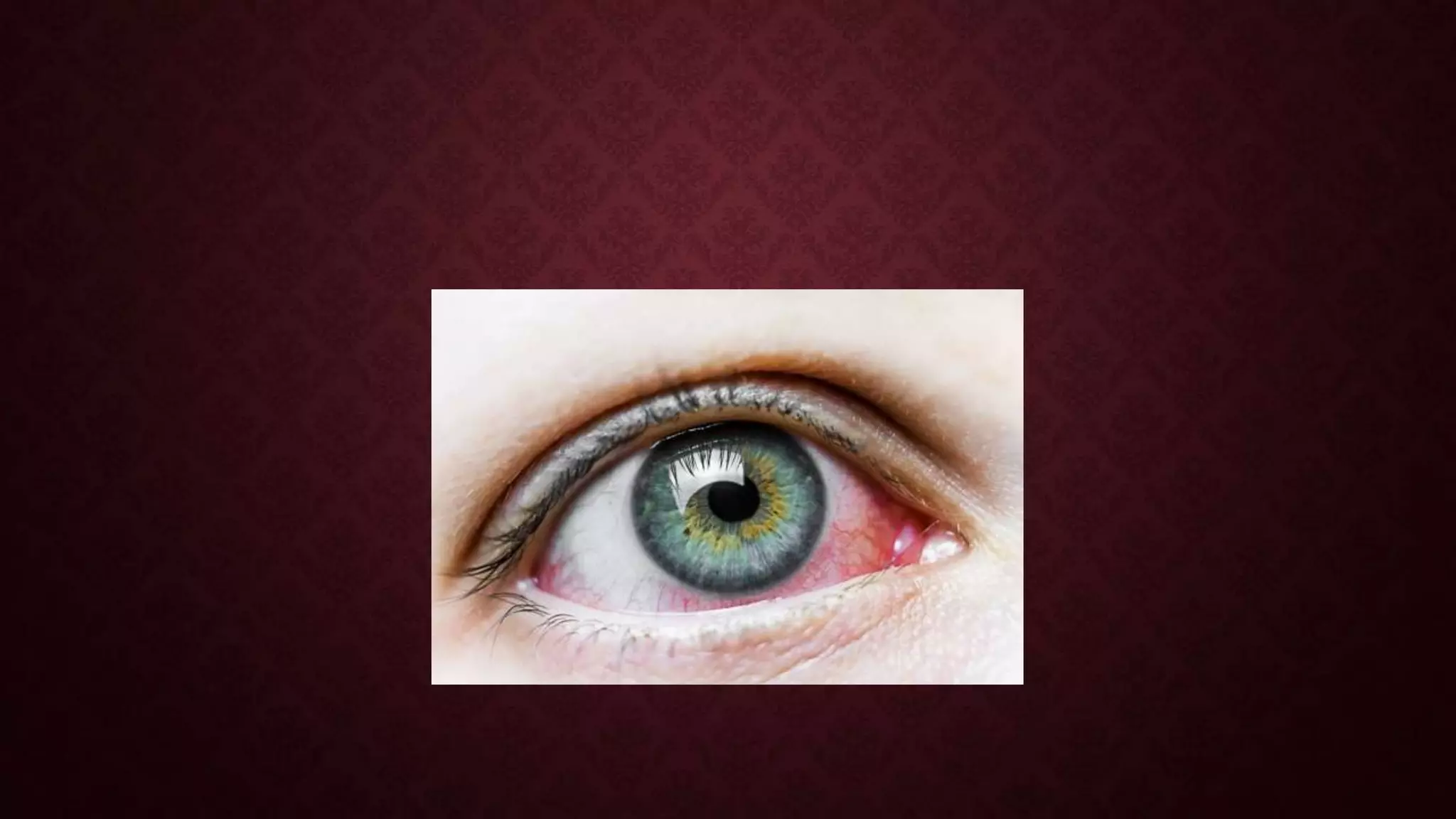 Hyperemia of conjuctiva.pptx