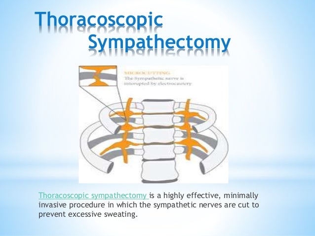 Thoracoscopic Sympathectomy Los Angeles | Hyperhidrosis MD
