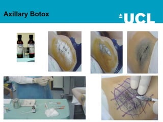 Hyperhidrosiss and retrodermal axillary curettage | PPT