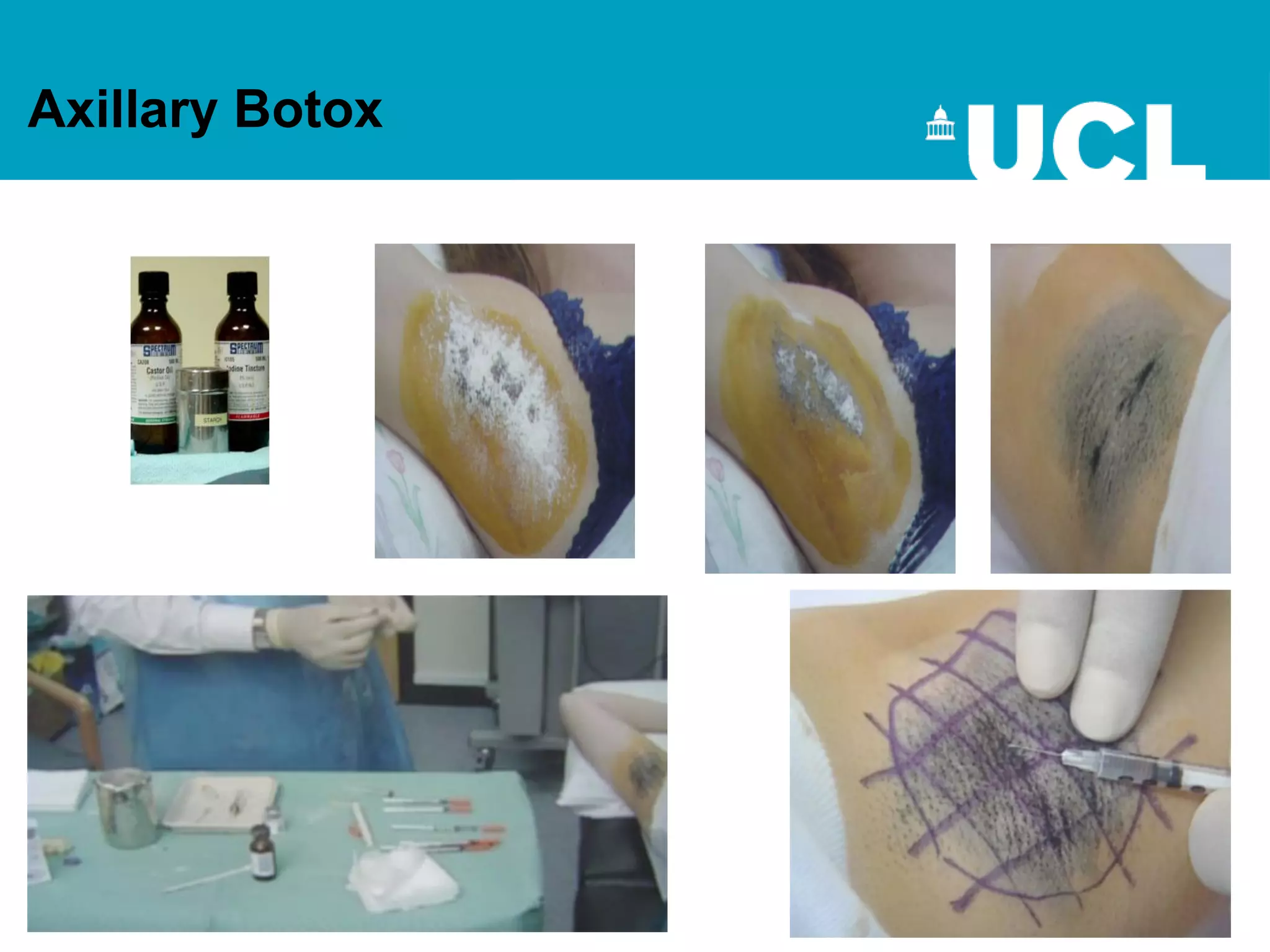Hyperhidrosis and retrodermal axillary curettage | PPT