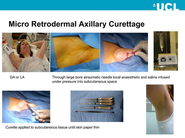 Hyperhidrosis and retrodermal axillary curettage | PPT