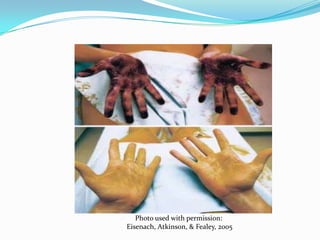 Hyperhydrosis ii | PPTX