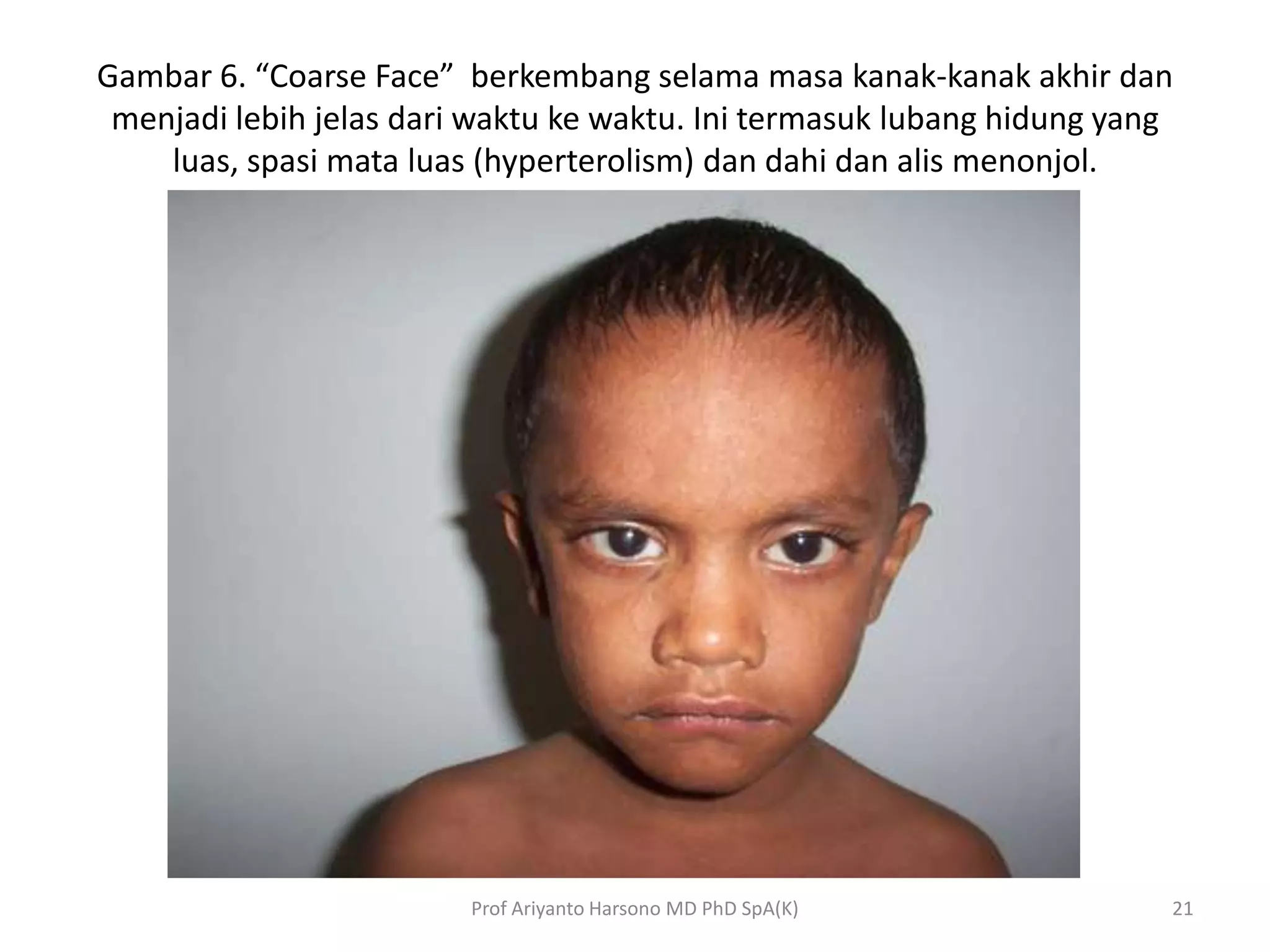 Hyper IgE Syndrome | PPTX
