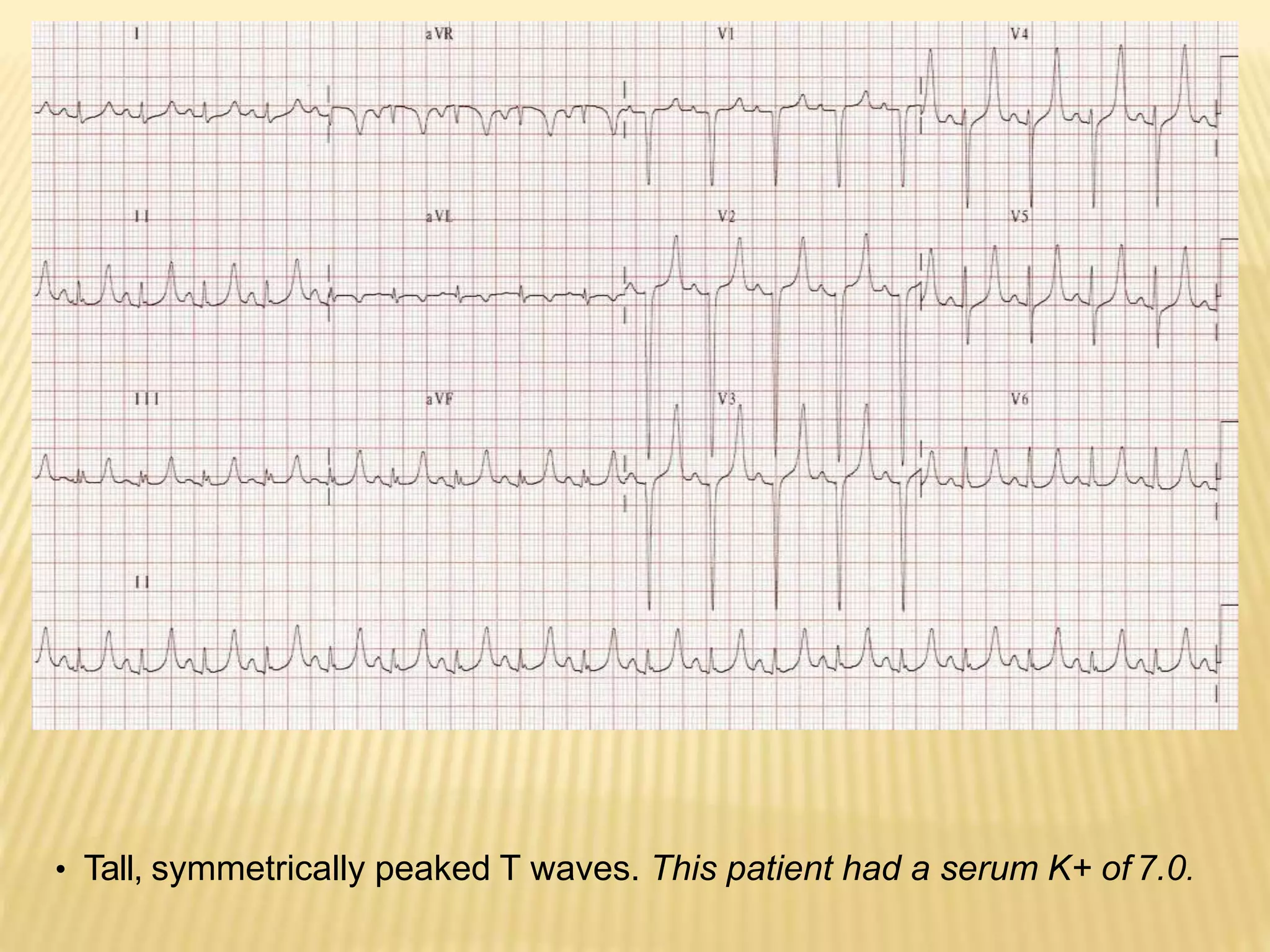 Diagnosis and management of Hyperkalemia | PPTX