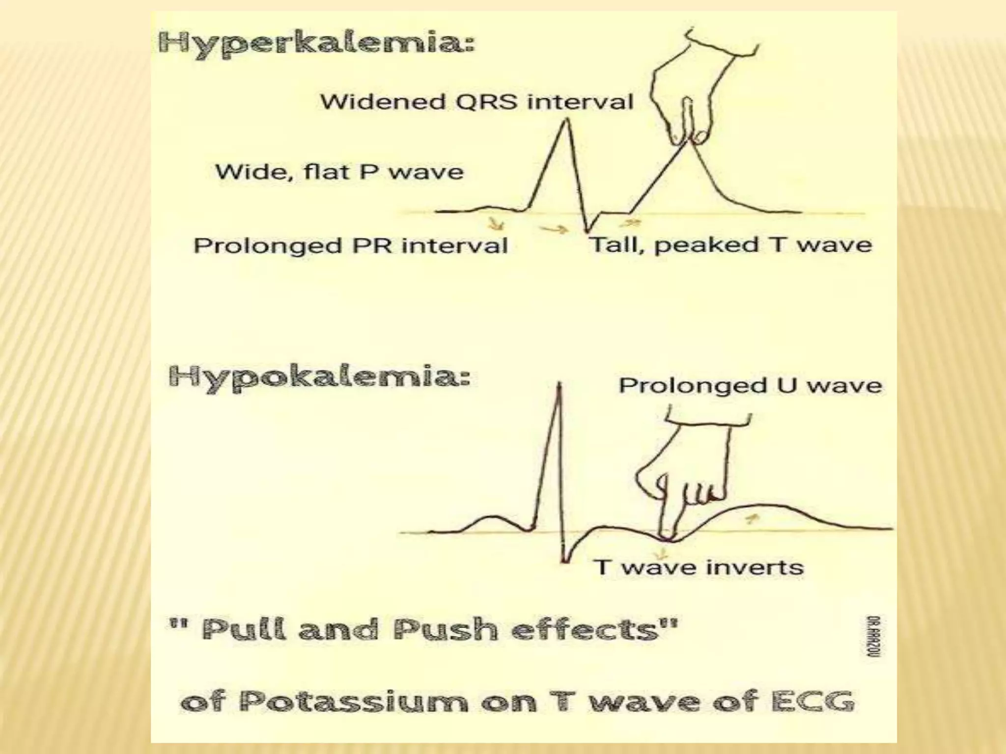 Diagnosis and management of Hyperkalemia | PPTX