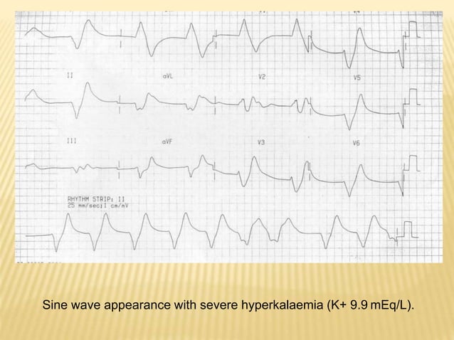 Approach to management of Hyperkalemia | PPTX | Endocrine and Metabolic ...